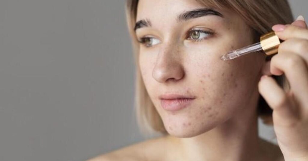 5 Acne Serums Dermatologists Often Recommend, The Fastest Way To Fade ...